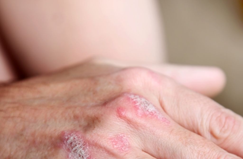 Autoimmunkrankheiten: Wenn der Körper sich selbst bekämpft - Wissen